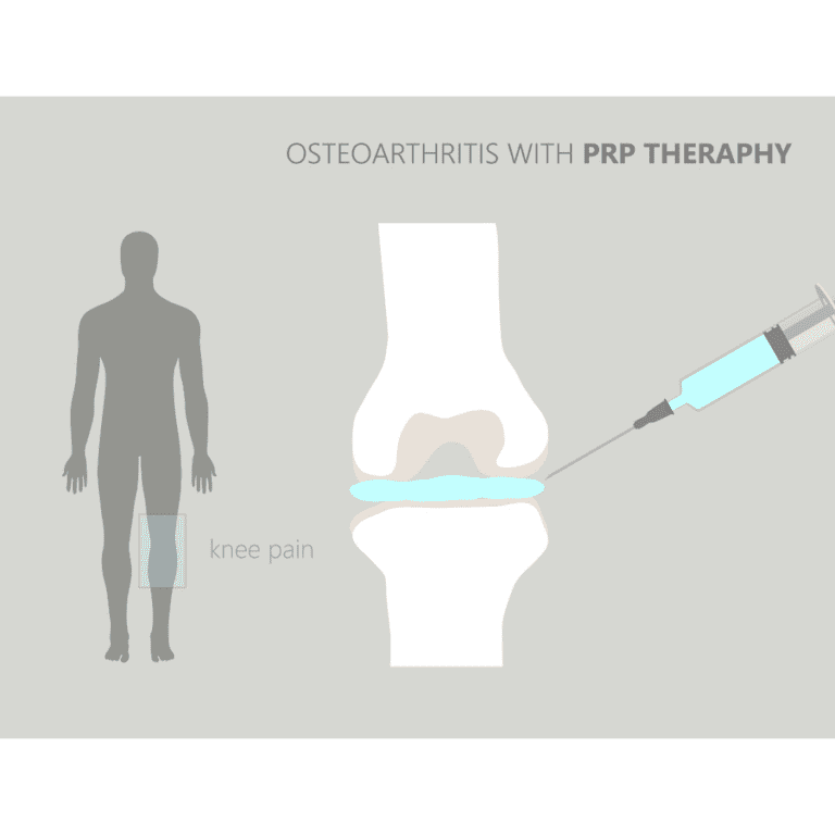 Platelet-Rich Plasma (PRP) Injection for Joint - Glow Aesthetic