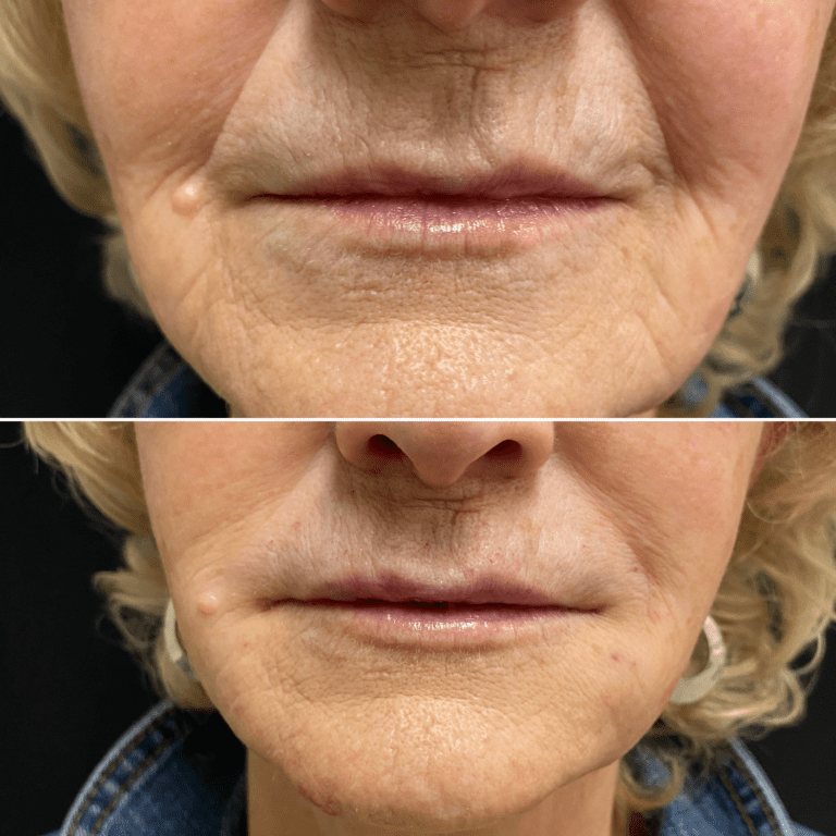 Injectable Fillers in Evansville IN - Glow Aesthetic