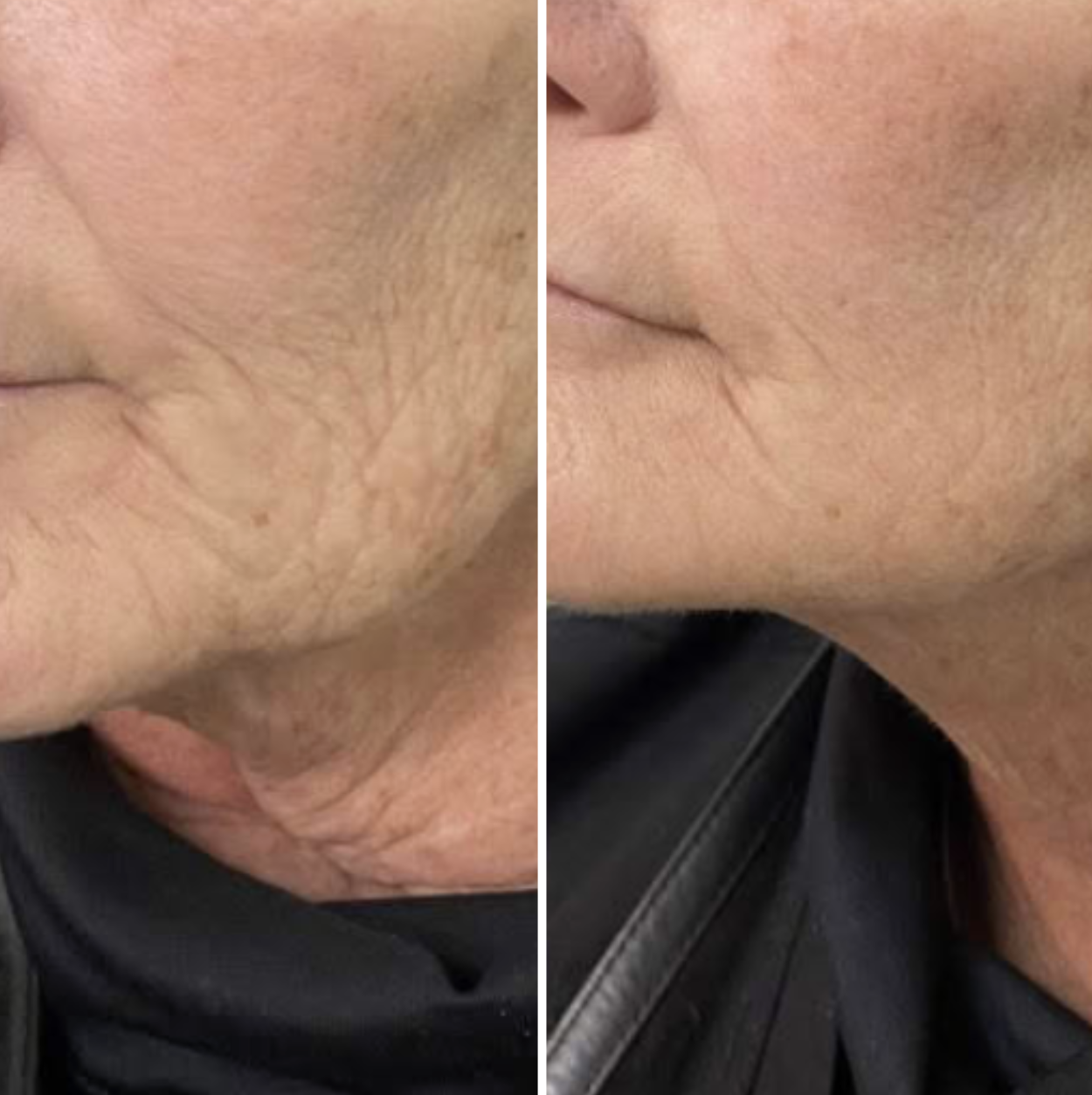 PDO Threads in Evansville IN - Glow Aesthetic