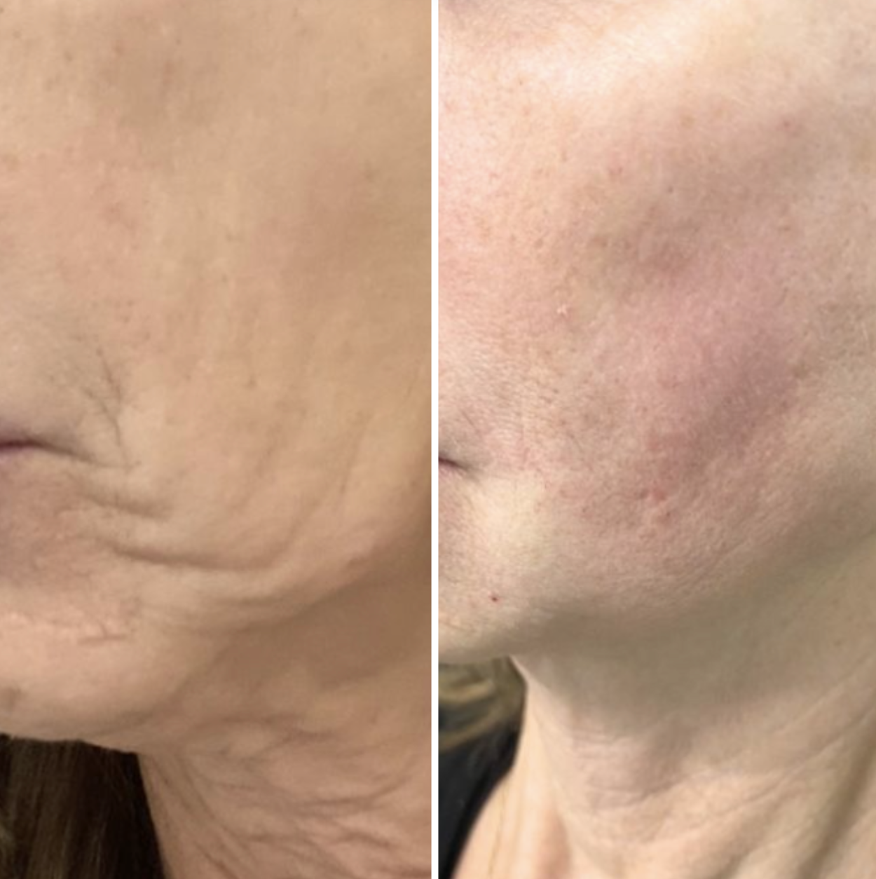 PDO Threads in Evansville IN - Glow Aesthetic