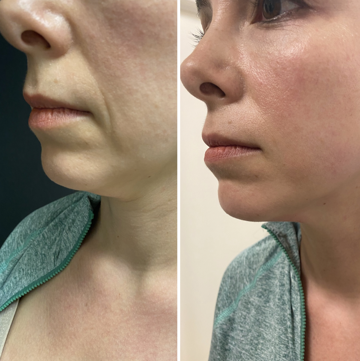 PDO Threads in Evansville IN - Glow Aesthetic