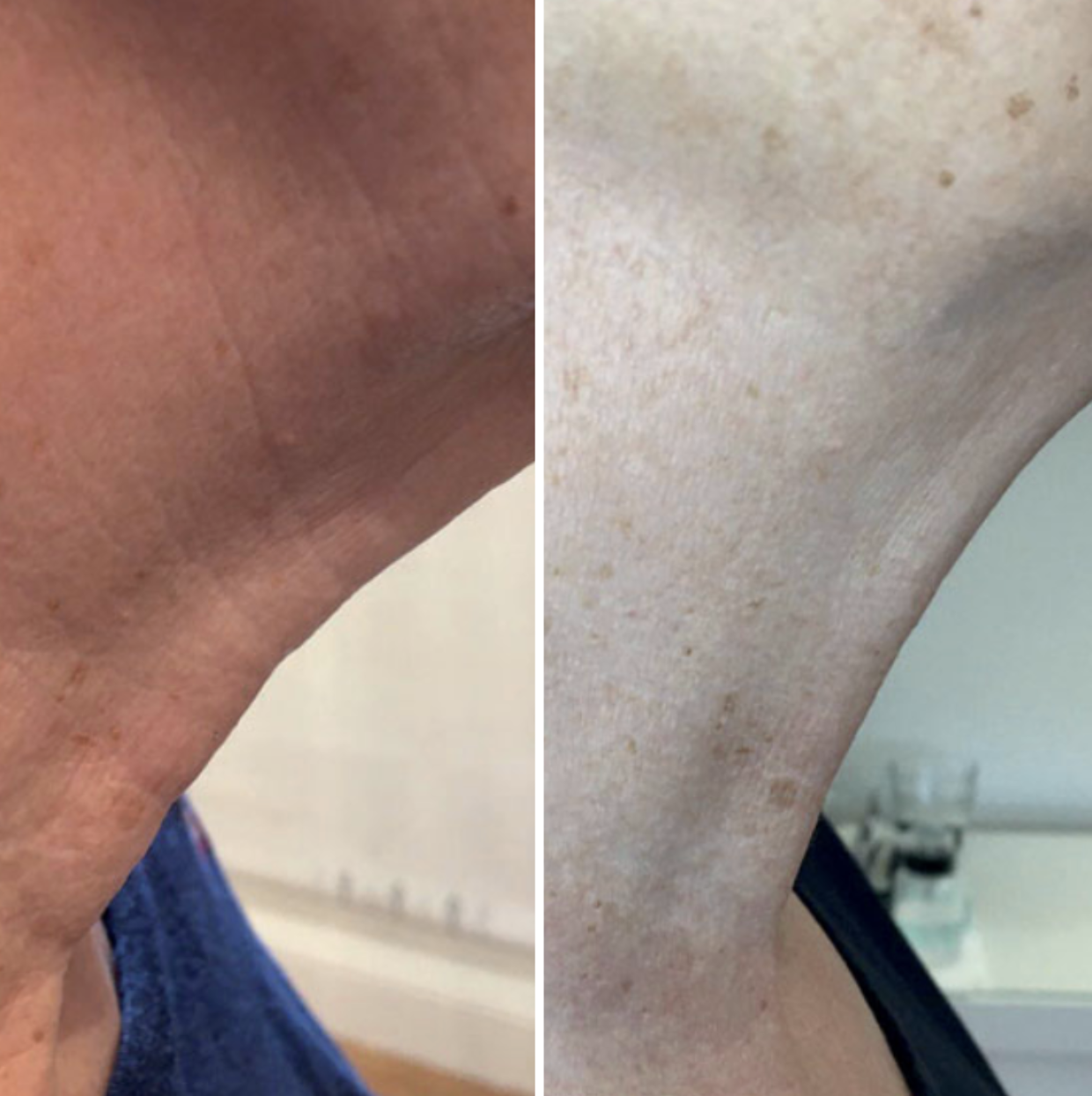 Plasma Lift - Glow Aesthetic