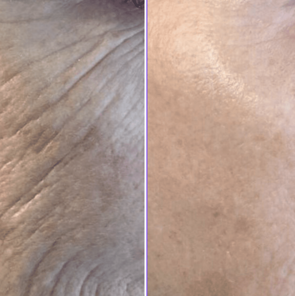 Plasma Lift - Glow Aesthetic