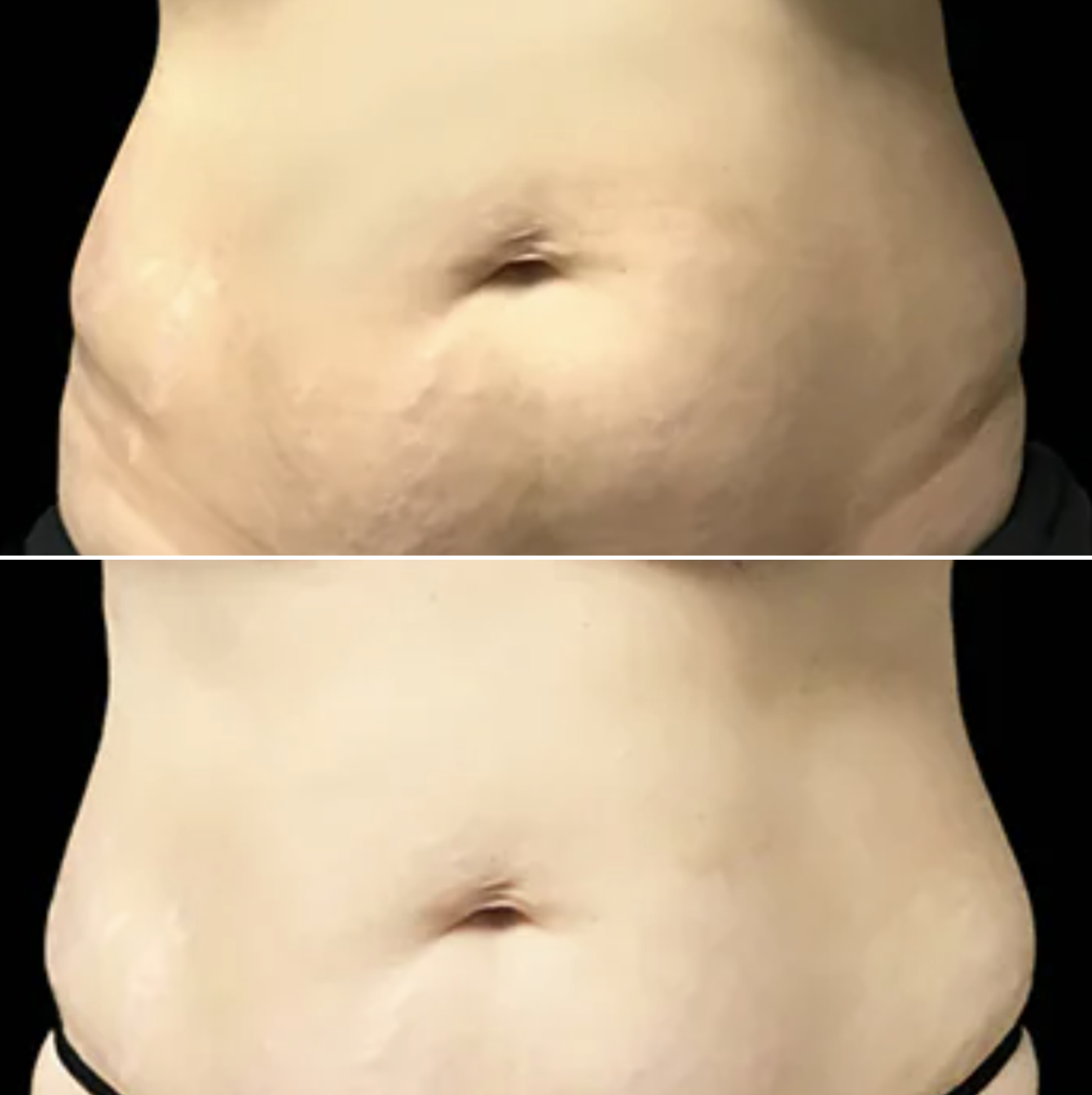 Radiofrequency (Body Sculpting & Skin Tightening) - Glow Aesthetic